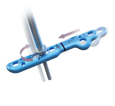 Arthrex - MaxForce™ MTP Fusion Plating System