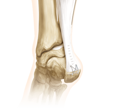 Arthrex - Punch for 5.5 mm Corkscrew FT, 4.75 mm and 5.5 mm SwiveLock ...