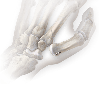 Arthrex - Trapeziectomy Tool with Handle, Sterile - AR-8919-01S