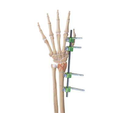 Arthrex - Arthrex Small External Fixator System