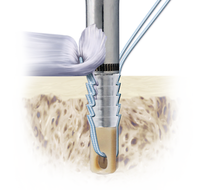 Arthrex - Soft Tissue Fixation Devices