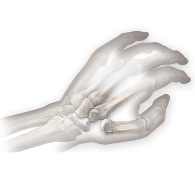 Arthrex - Implant System, CMC Mini TightRope, 1.1 mm - AR-8919DS