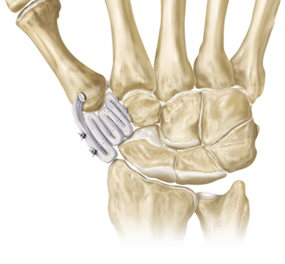Arthrex - Soft Tissue Fixation Devices