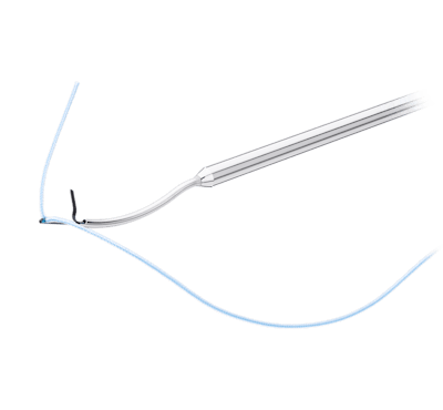 Arthrex - Hip Capsular Closure Using LoopLoc™ Knotless Implant