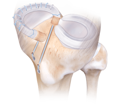 Arthrex - Meniscal Transplant Procedure