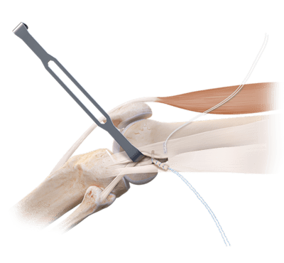 Arthrex - ACL TightRope RT with Titanium and UHMWPE - AR-1588RT