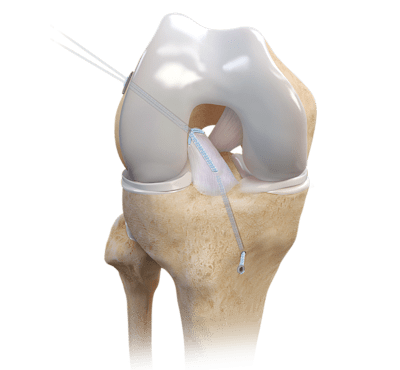 Arthrex - Tibial Spine Avulsion Fracture Reduction Using ACL Repair ...