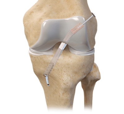 Arthrex - BTB ACL Reconstruction Using the BTB TightRope® II Implant ...