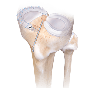 Arthrex - Meniscal Fixation and Transplant