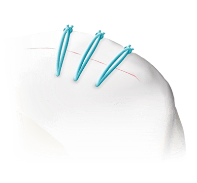 Arthrex - Meniscus Repair Rasp - AR-4130