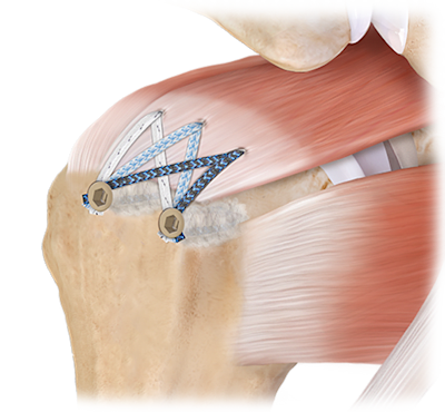Arthrex - FiberTak® SpeedBridge™ Rotator Cuff Repair With Lateral Row ...