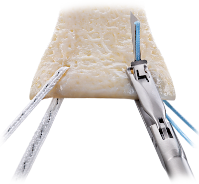 Arthrex - CuffMend™ Rotator Cuff Repair Augmentation System