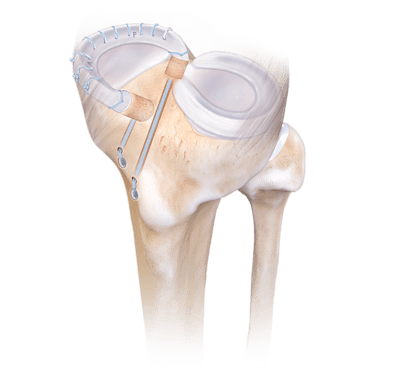 Arthrex - Femoral ACL Marking Hook for RetroConstruction Drill Guide ...