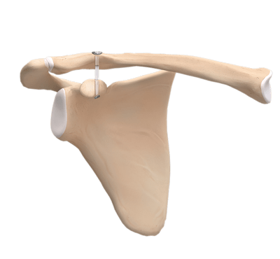 Arthrex - Knotless AC TightRope Open Repair Implant with Pec Button ...