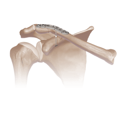 Arthrex - Distal Clavicle Fracture Repair