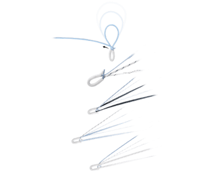 Arthrex - Shoulder Labral Repair With the 1.8 Knotless FiberTak® Soft ...