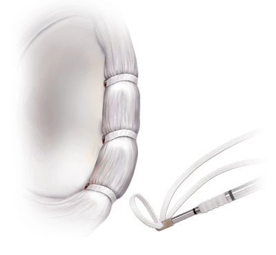 Arthrex - CuffMend™ Rotator Cuff Repair Augmentation System