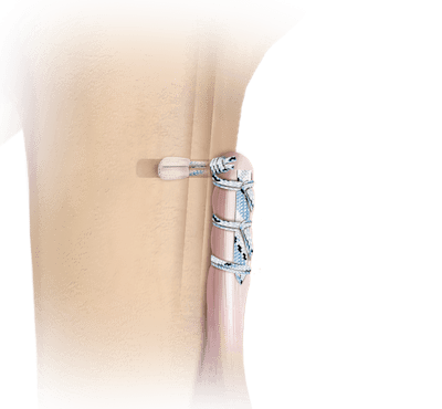 Arthrex - Specialty Suture