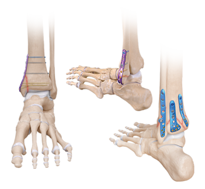 Arthrex - Ankle Fracture ORIF Utilizing the Syndesmosis TightRope® Fixation