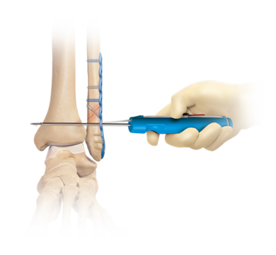 Arthrex - Syndesmosis TightRope XP Buttress Plate Implant System ...