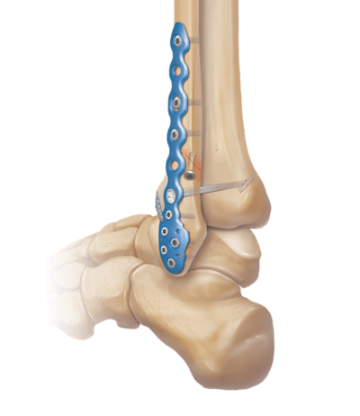 Arthrex - Ankle Fracture ORIF Utilizing the Syndesmosis TightRope® Fixation