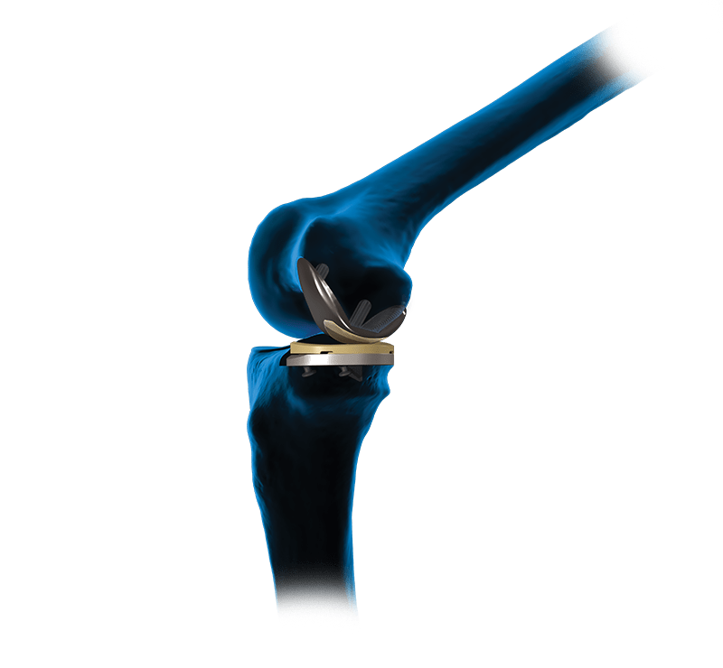 Arthrex - Unicondylar Knee Arthroplasty (UKA)