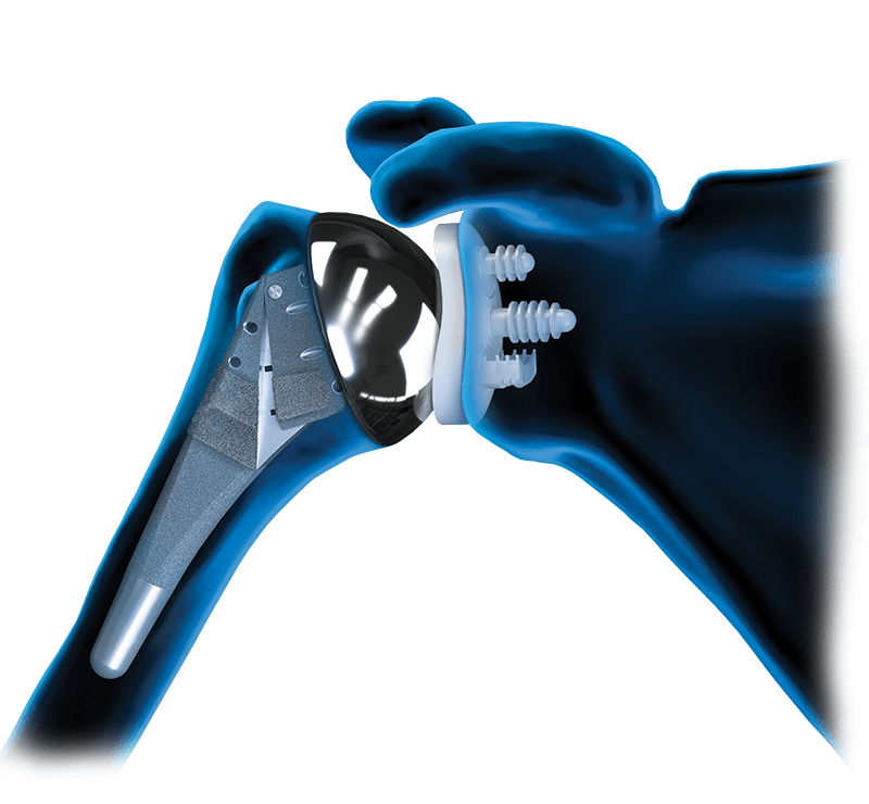 Arthrex - Univers Apex OptiFit™ Total Shoulder System