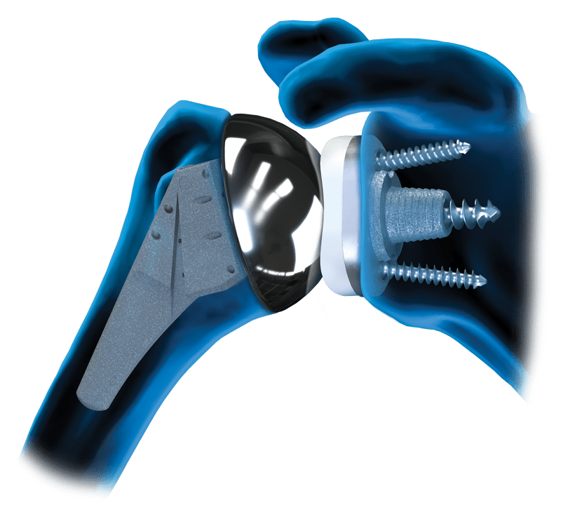 Arthrex - Univers™ Apex Total Shoulder System