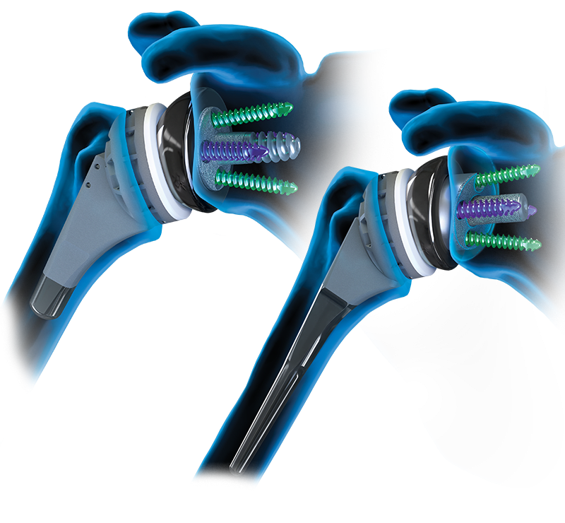 Arthrex - Univers Revers™ Total Shoulder System