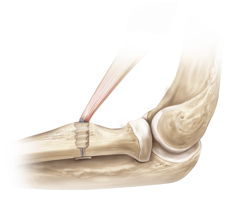 Arthrex - BicepsButton™ Implant Systems