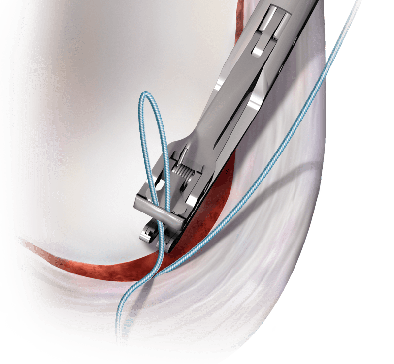 Arthrex - Suture Passers