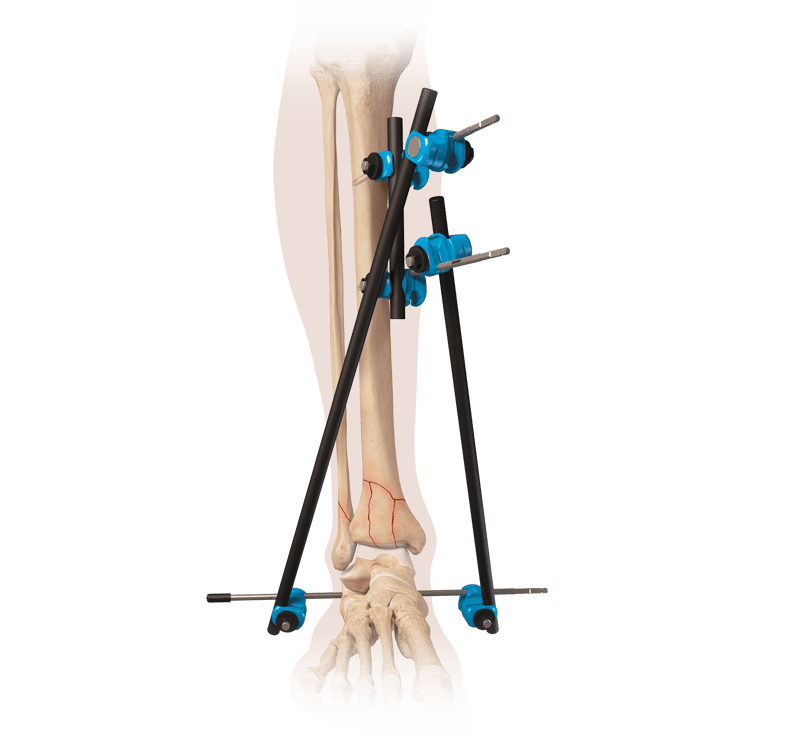 Arthrex - External Fixation
