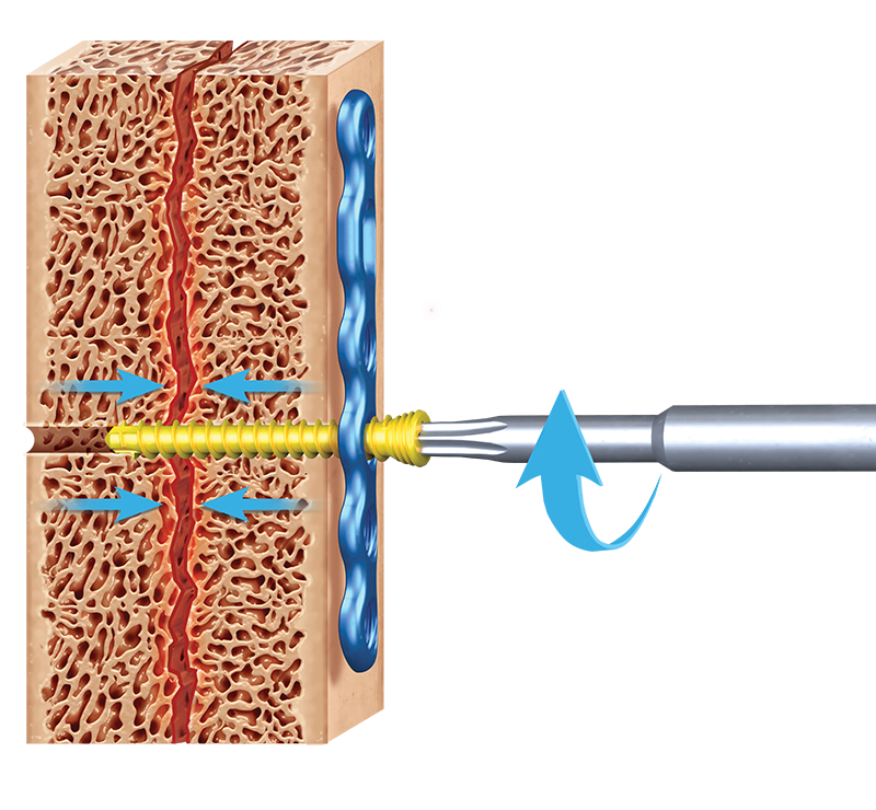 Arthrex - KreuLock™ Locking Compression Screws