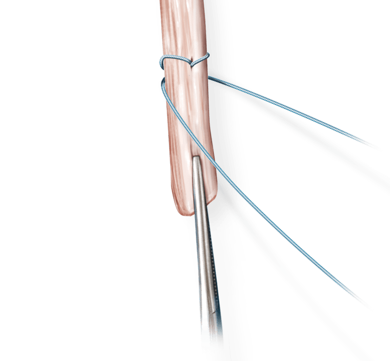 Arthrex - Reparación del tendón flexor/extensor con sutura FiberWire®