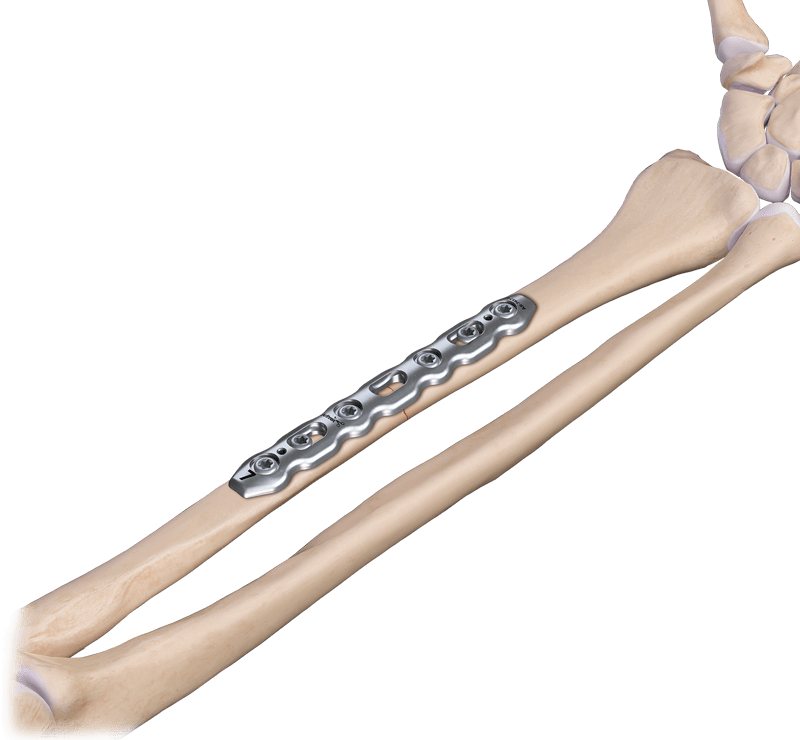 Arthrex - Locking 3.5 mm Compression Plates