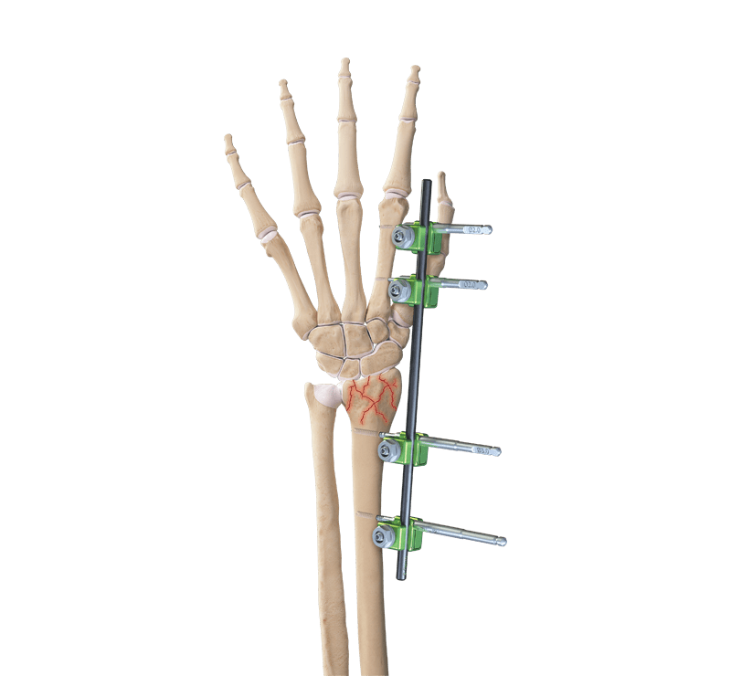 Arthrex - Small External Fixator
