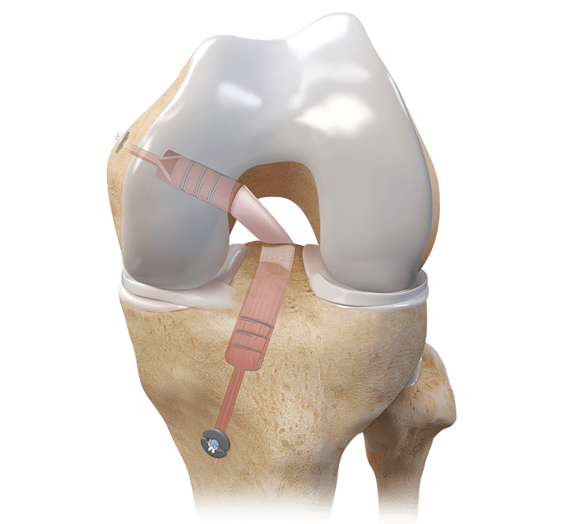 Arthrex - Posterior Cruciate Ligament (PCL) Reconstruction