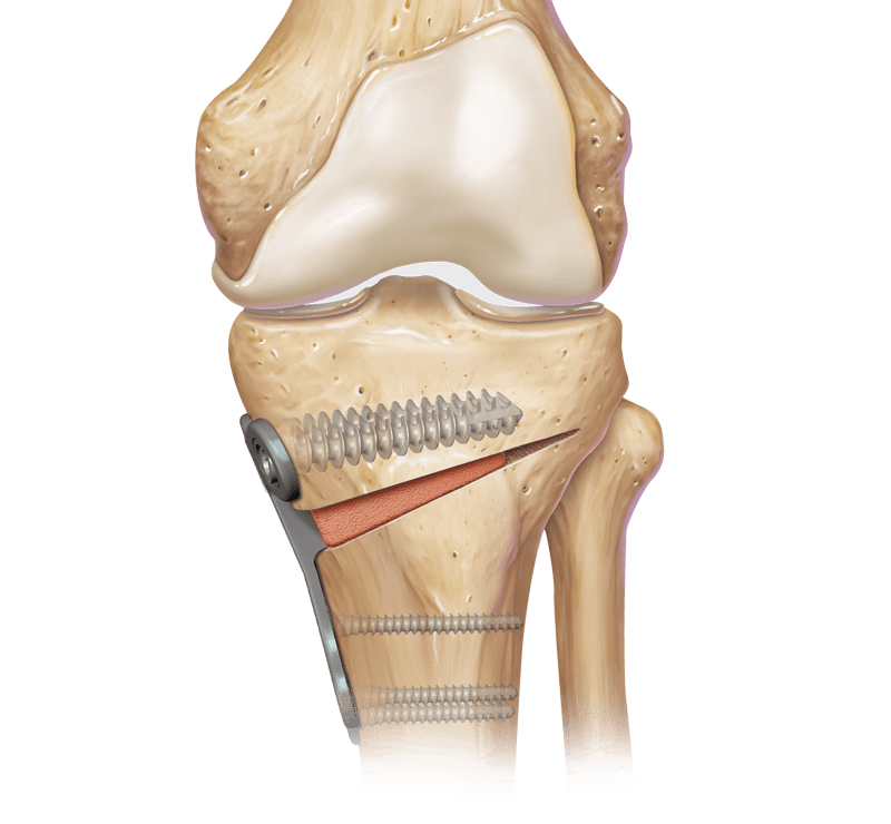 Arthrex - Tibial Opening Wedge