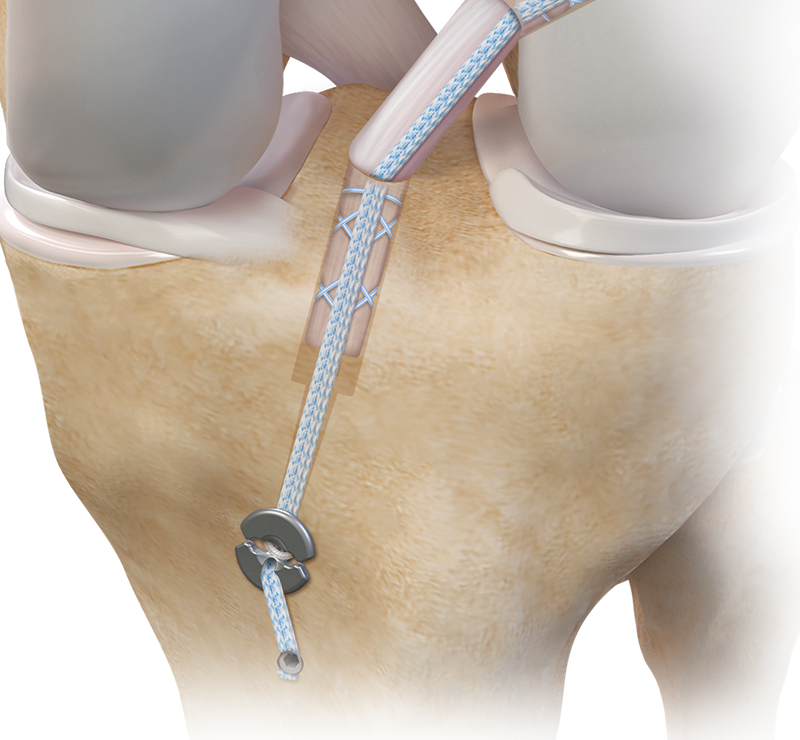 Arthrex - TightRope® II Attachable Button System