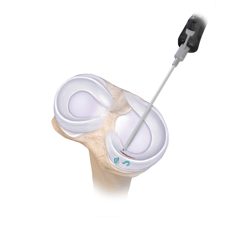 Arthrex - Fijación y transplante meniscal