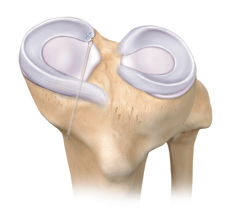 Arthrex - SutureLoc™ Implant