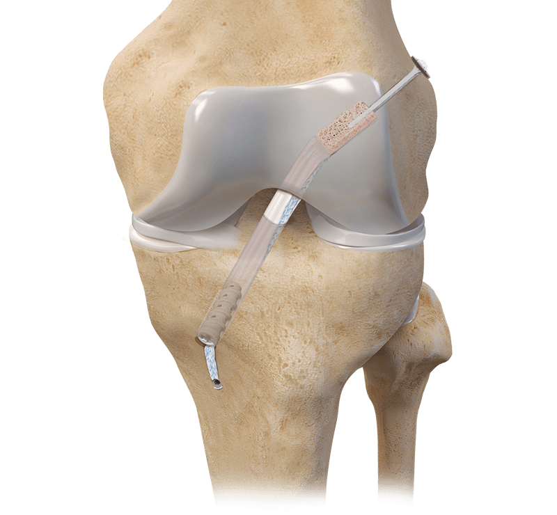 Arthrex - TightRope® II BTB Implant