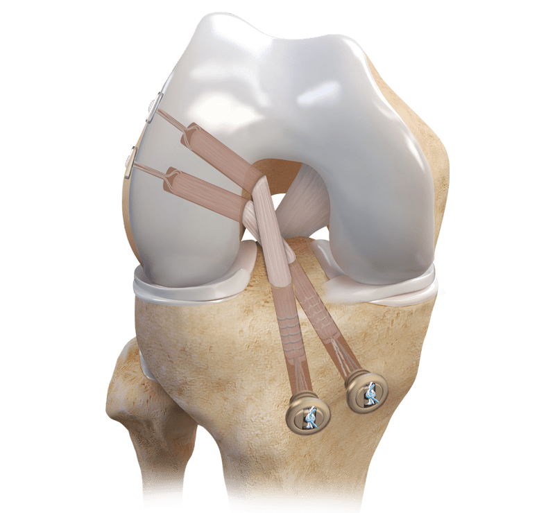 Arthrex - Posts, Washers and Staples