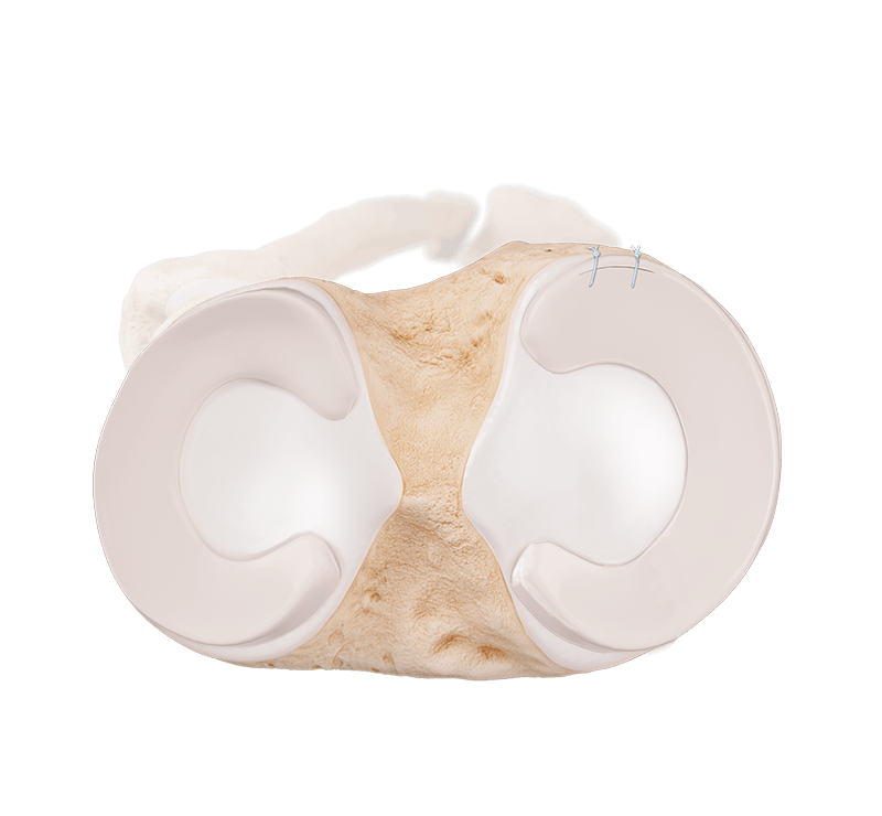 Arthrex - Meniscus Ramp Lesion