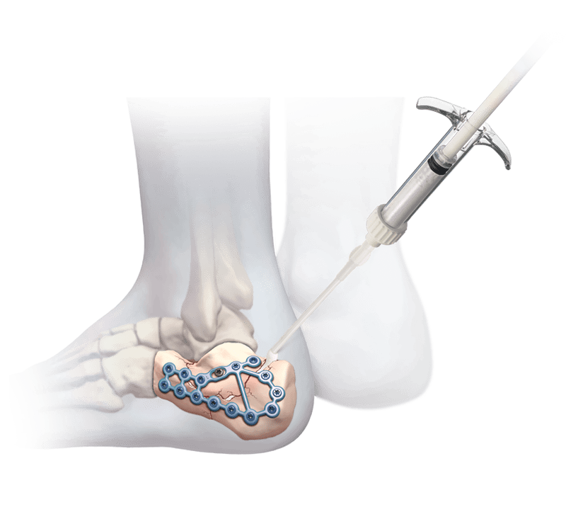 Arthrex - BoneSync™ Synthetic Bone Void Fillers
