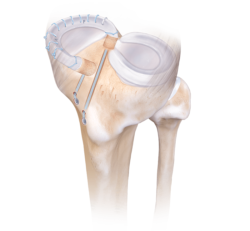 Arthrex - Double Bone Plug