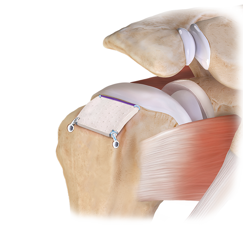 Arthrex - Biologic Tuberoplasty Technique