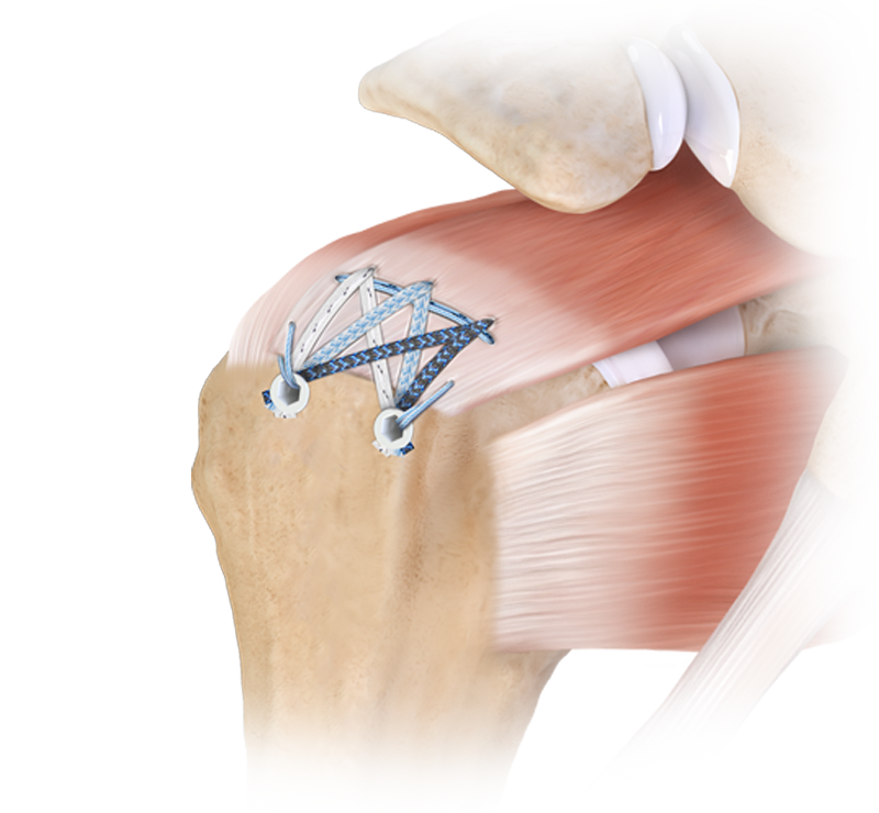 Arthrex - Knotless Rotator Cuff Repair