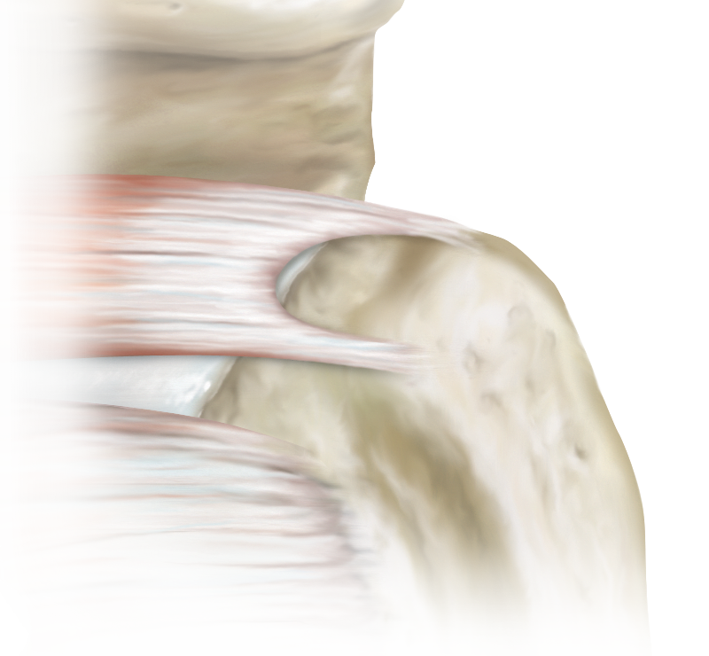 Arthrex - Rotator Cuff Tear