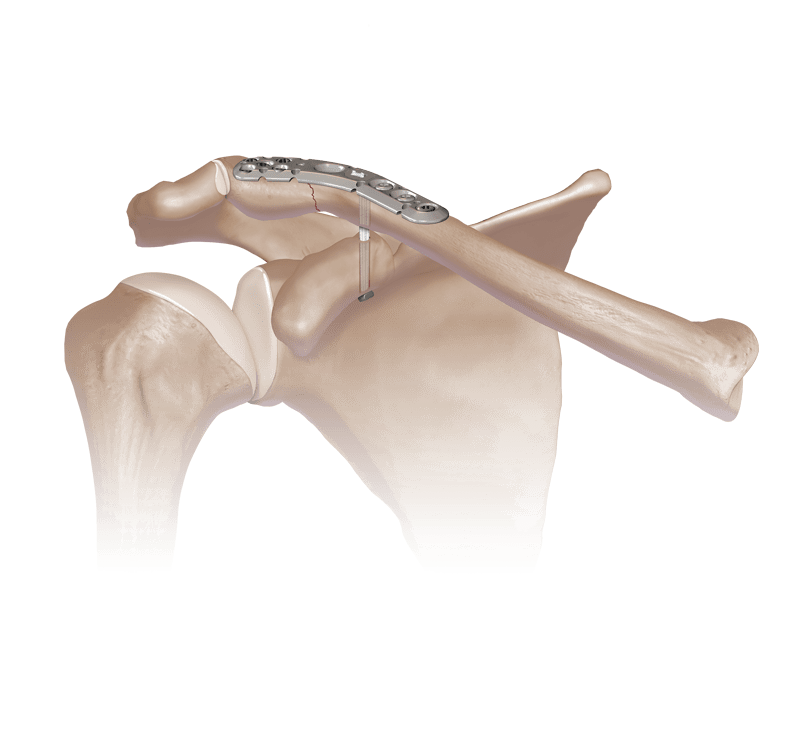 Arthrex - Clavicle Plates and Screws